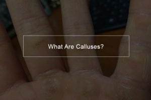 What does a Callus look like? - Stopyourskinproblem.com