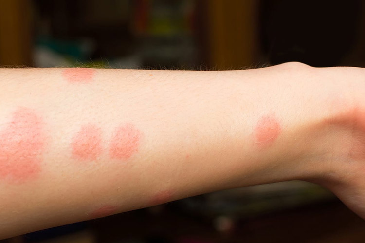 What does a flea bite look like? - Stopyourskinproblem.com