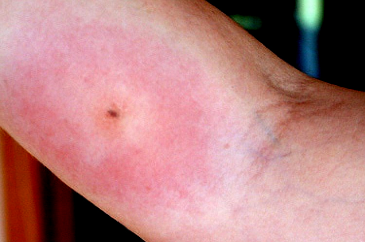 What do spider bites look like on humans? - Stopyourskinproblem.com